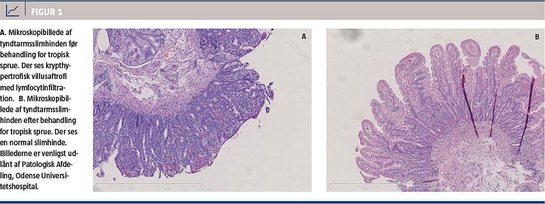 Tropisk sprue som differentialdiagnose til cøliaki hos patient i ...