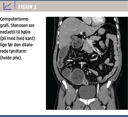 Vellykket endoskopisk dilatation af stenoseret ileorektal anastomose ...