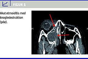 Akut etmoiditis kan medføre blindhed | Ugeskriftet.dk