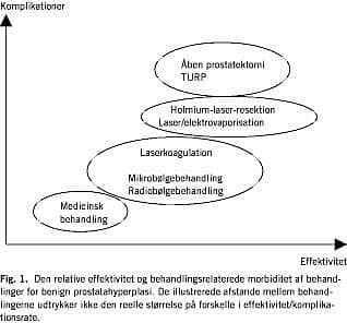 Minimalt invasiv behandling af benign prostatahyperplasi | Ugeskriftet.dk