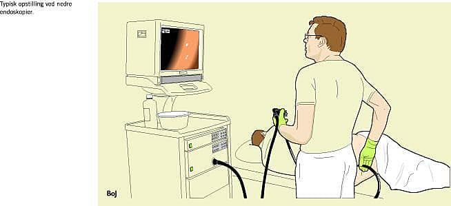 Sigmoideoskopi | Ugeskriftet.dk