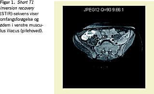 Pyomyositis uden feber hos 12-årig pige | Ugeskriftet.dk