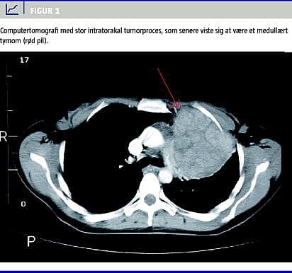 Goods syndrom med både lymfopeni og neutropeni | Ugeskriftet.dk