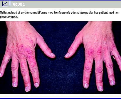Recidiverende erythema multiforme udløst af herpes simplex-virus ...