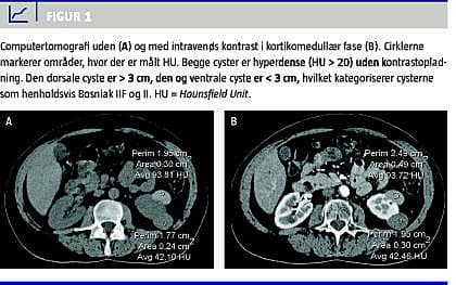 Karakterisering af komplekse cyster i nyrerne | Ugeskriftet.dk