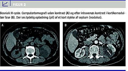 Karakterisering af komplekse cyster i nyrerne | Ugeskriftet.dk