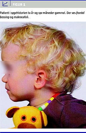 Bannayan-Riley-Ruvalcabas syndrom og juvenil polypose hos en toårig ...