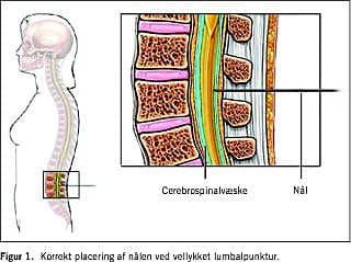 Lumbalpunktur | Ugeskriftet.dk
