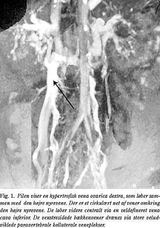 Vena cava inferior atresi som årsag til dyb venetrombose | Ugeskriftet.dk