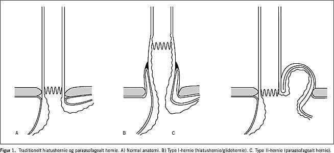Laparoskopisk behandling af paraøsofageale hernier | Ugeskriftet.dk