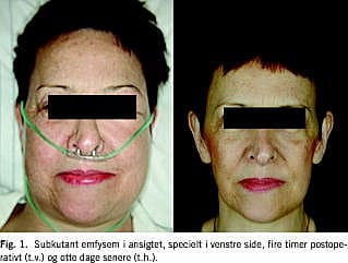 Subkutant emfysem, atrieflagren og prækordiale brystsmerter udløst af ...