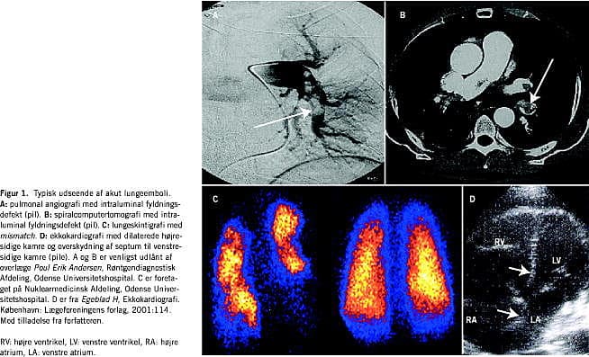 Billeddiagnostik ved akut lungeemboli | Ugeskriftet.dk