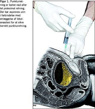 Anlæggelse af suprapubisk kateter | Ugeskriftet.dk