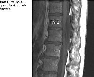 Symptomatiske perineurale cyster | Ugeskriftet.dk