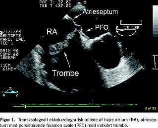 Lungeemboli kompliceret af højresidig intrakardiel trombe fastsiddende ...