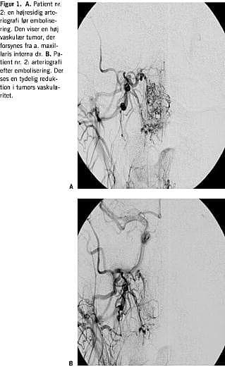 Behandling af juvenile angiofibromer med partikelembolisering og ...