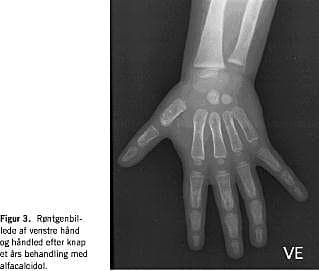 D-vitamin-1 α -hydroxylase-mangel som årsag til svær rakitis hos en ...