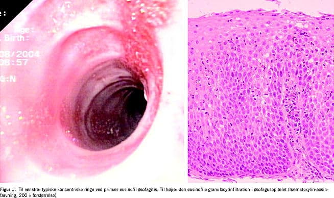 Primær eosinofil øsofagitis | Ugeskriftet.dk
