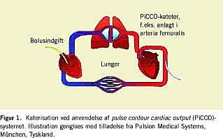 Kredsløbsmonitorering af kritisk syge patienter med »pulse contour ...