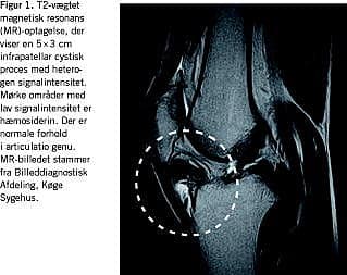 Knæsmerter - lokaliseret pigmenteret villonodulær synovitis ...