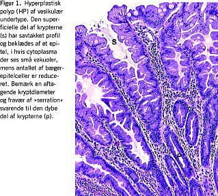 Serrate, hyperplastiske - og hyperplasilignende, kolorektale polypper ...