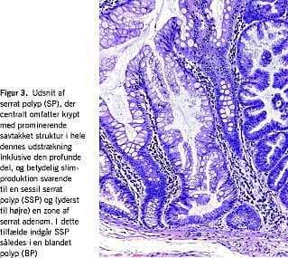 Serrate, hyperplastiske - og hyperplasilignende, kolorektale polypper ...