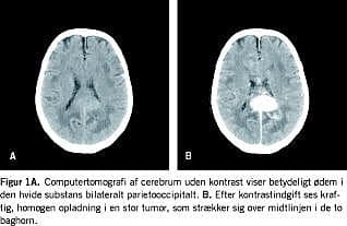 Primære non-Hodgkin-lymfomer i centralnervesystemet | Ugeskriftet.dk