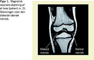 Diskoid lateral menisk som årsag til halten hos børn | Ugeskriftet.dk