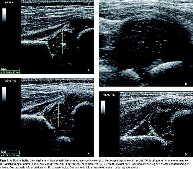 Ultralydskanning ved diagnostik og behandling af hoftedysplasi | Ugeskriftet.dk
