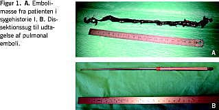 Kirurgisk behandling af lungeemboli | Ugeskriftet.dk