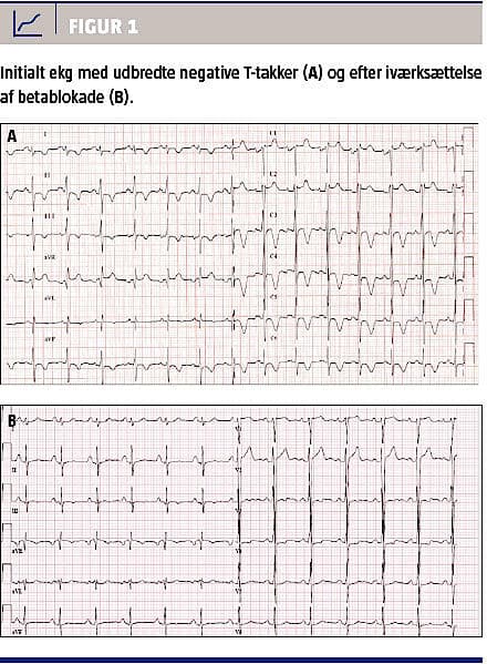 LEOPARD-syndrom er en sjælden tilstand, som ofte er ledsaget af fregner ...