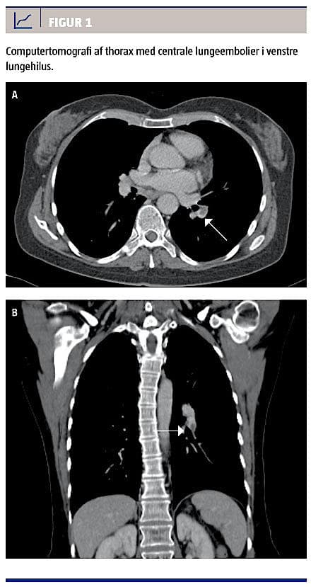 Forhøjet immunglobulin E-koncentration kan skyldes lungeemboli ...