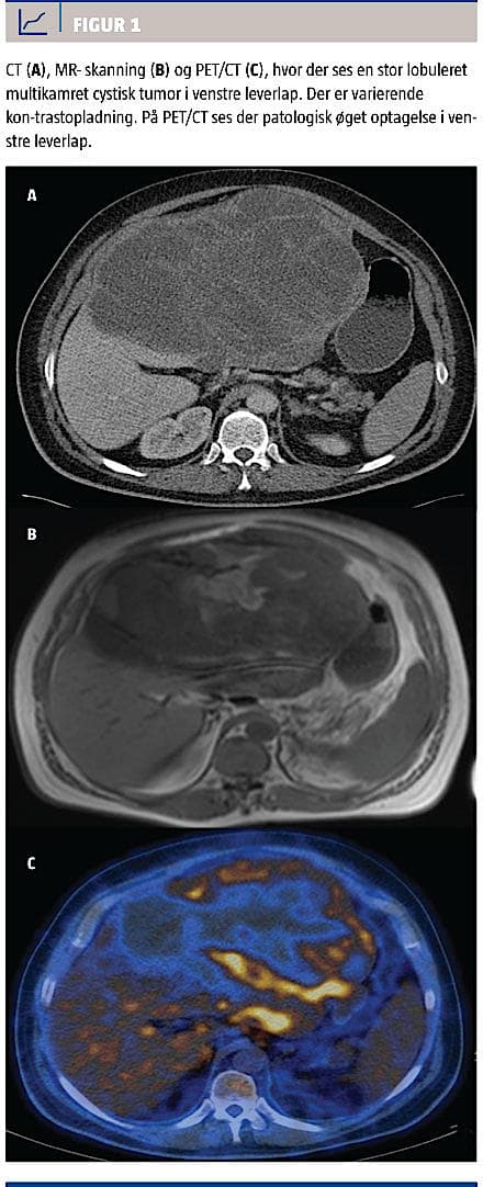 Hepatisk angiosarkom som billeddiagnostisk differentialdiagnose til ...