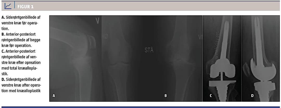 Kongenit korsbåndsaplasi som årsag til gonartrose | Ugeskriftet.dk