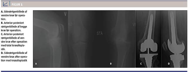 Kongenit korsbåndsaplasi som årsag til gonartrose | Ugeskriftet.dk