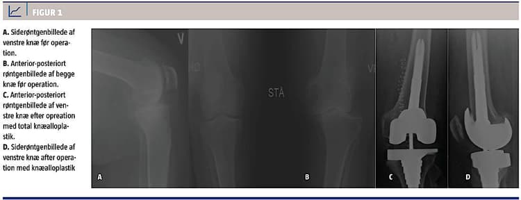 Kongenit korsbåndsaplasi som årsag til gonartrose | Ugeskriftet.dk
