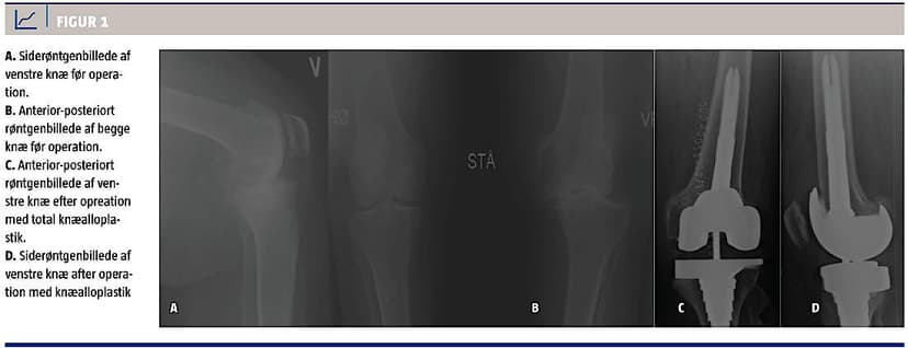 Kongenit korsbåndsaplasi som årsag til gonartrose | Ugeskriftet.dk