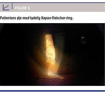 Wilsons sygdom debuterer ofte med psykiatriske symptomer | Ugeskriftet.dk