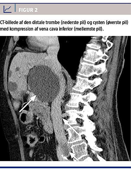 Stor levercyste som årsag til dyb venetrombose i benet | Ugeskriftet.dk
