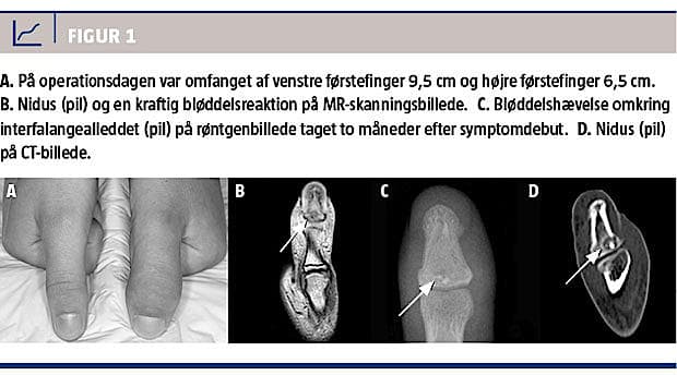 Osteoidt osteom i phalanx distalis af en førstefinger | Ugeskriftet.dk
