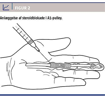 Subkutan atrofi efter steroidinjektion i forbindelse med behandling af ...