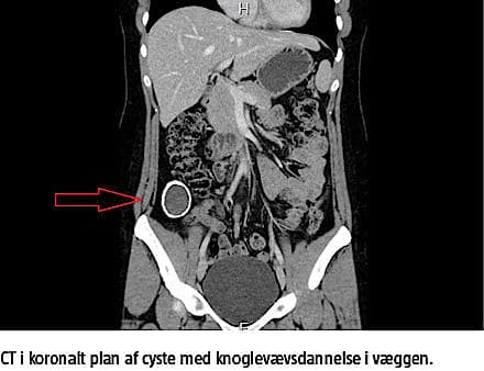 Retroperitoneal benign cyste med ossøs metaplasi som årsag til ...