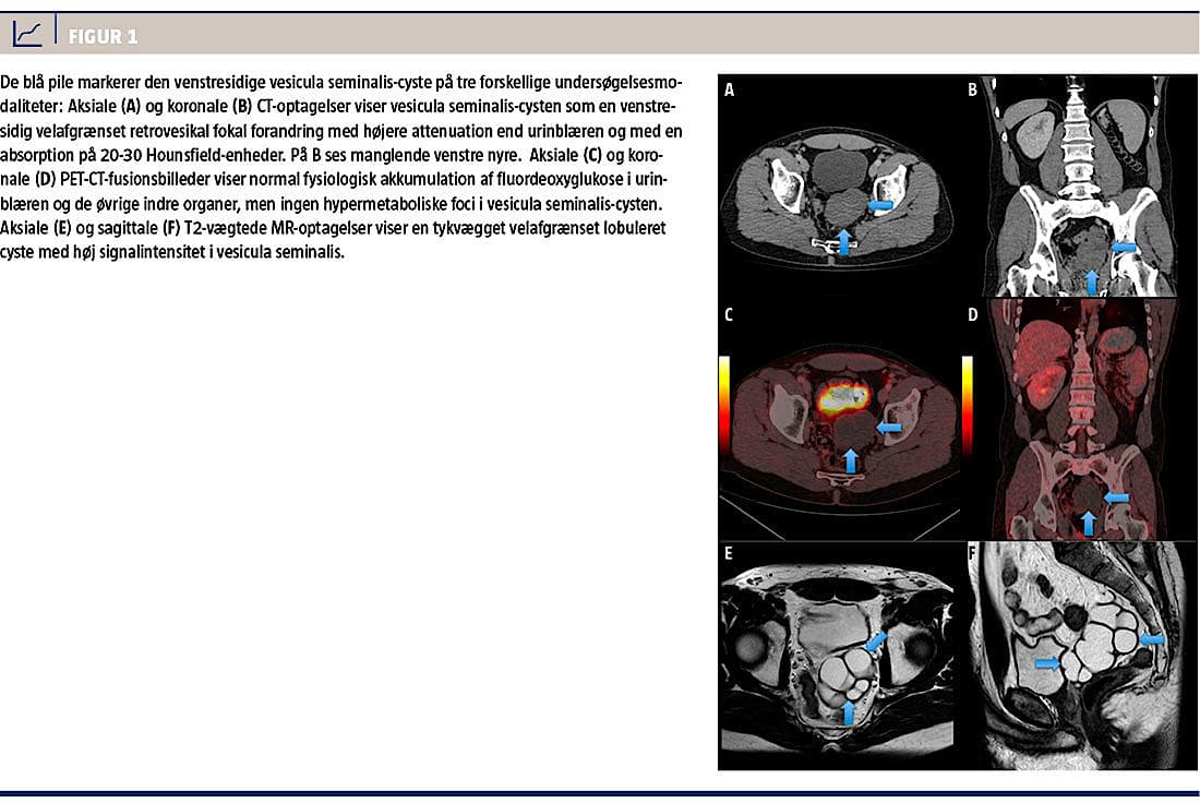 Vesicula seminalis-cyste med ipsilateral nyreagenesi | Ugeskriftet.dk
