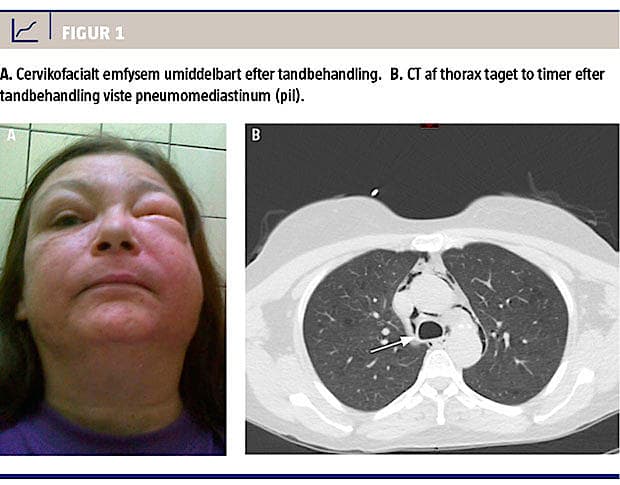 Cervikofacialt emfysem og pneumomediastinum efter tandbehandling ...