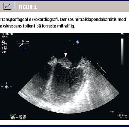 Atypisk manifestation ved infektiøs endokarditis | Ugeskriftet.dk