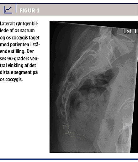 Svær obstipation som følge af abnormt vinklet os coccygis | Ugeskriftet.dk
