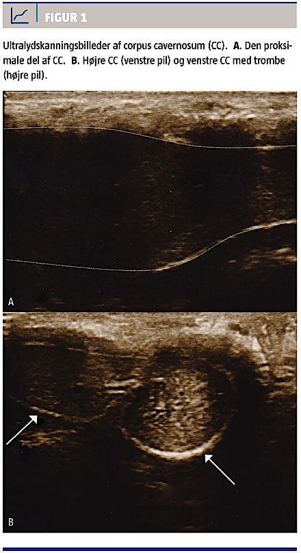 Partiel priapisme | Ugeskriftet.dk