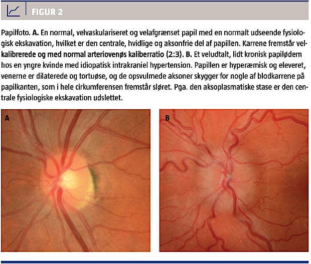 Papilødem | Ugeskriftet.dk