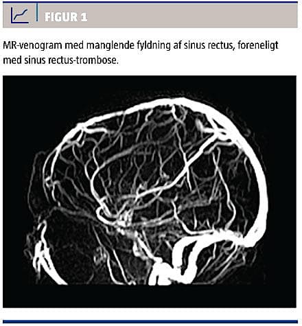 Diagnose og behandling af cerebral venøs sinustrombose | Ugeskriftet.dk