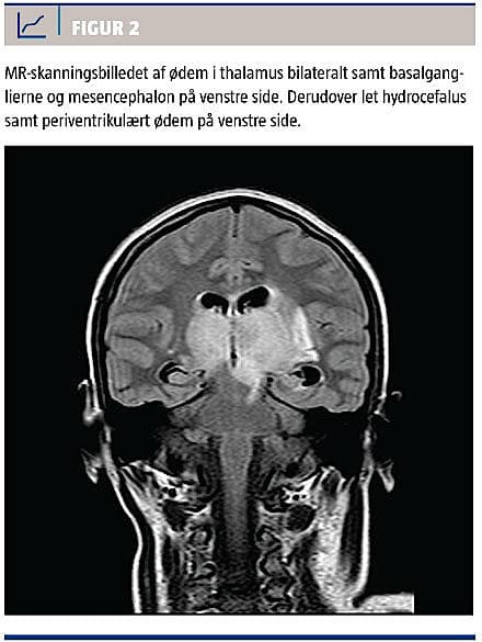 Diagnose og behandling af cerebral venøs sinustrombose | Ugeskriftet.dk
